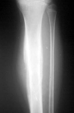 Sarcoma de Ewing: Relato de um caso com acometimento da tíbia.